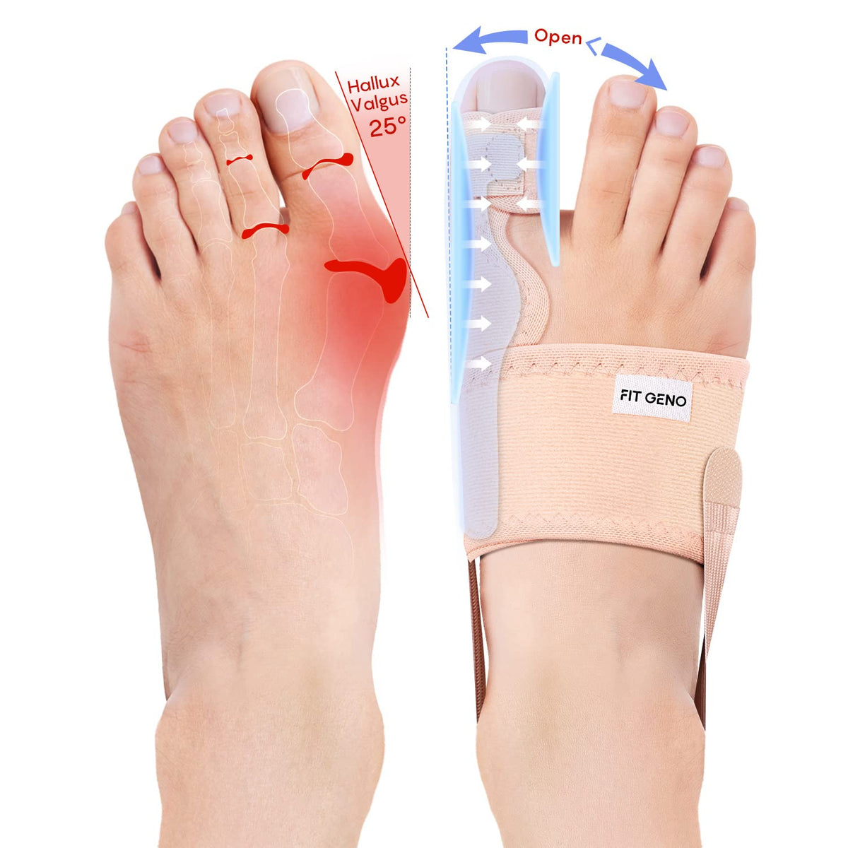 Fit Geno 1 Pair Orthopedic Hallux Valgus Toe Spacer – Adjustable Day ...